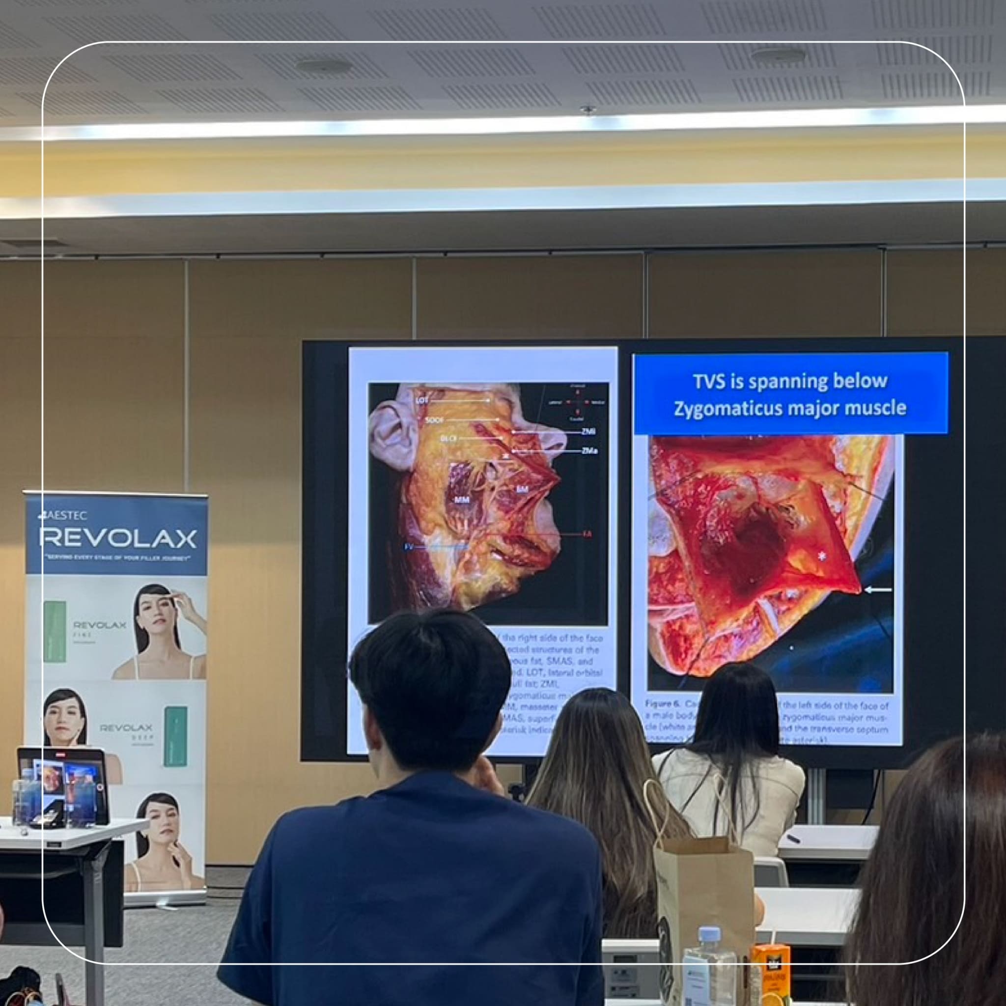 โปรแกรมฟิลเลอร์ Revolax ทางเลือกที่ตอบโจทย์ทุกความงาม - Cosmo Clinic